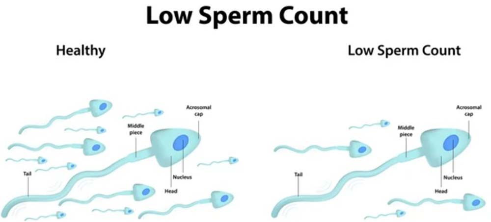 Sperm count is declining at accelerating rate worldwide - St