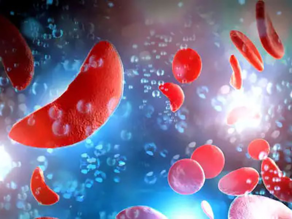 Test for sickle cell before getting children – Medics